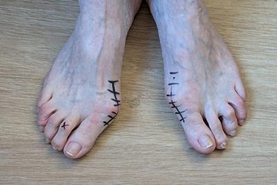 Preparing for Bunion Surgery: Checklist for a Smooth Experience