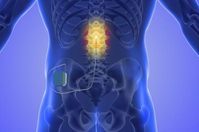 How a Spinal Cord Stimulator Can Improve Your Quality of Life