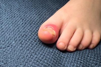 What Causes Ingrown Toenails and How to Treat Them