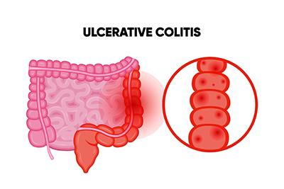Ulcerative Colitis and Other Digestive Complications