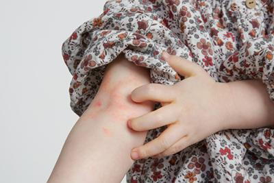 Understanding Childhood Eczema: Causes and Treatments