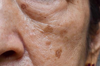 How Brown Spots Are Linked to Aging and How Dermatologists Can Help