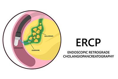 Is ERCP the Right Choice for Your Digestive Health Concerns?
