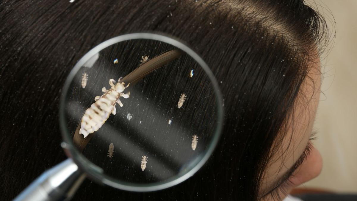 Head Lice: Kidsville Pediatrics Southlake Offers Expert Solutions