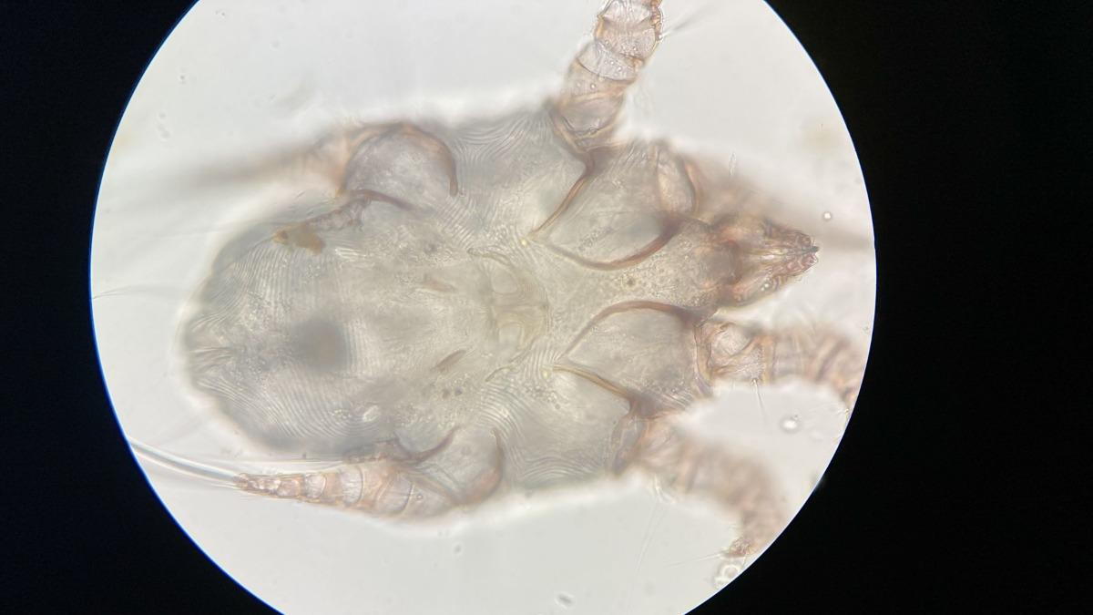 Scabies Treatment for Kids: Stop the Itch for Good