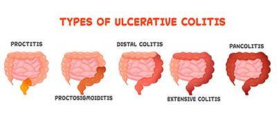 How Ulcerative Colitis Can Affect Your Nutritional Health
