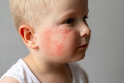 Recognizing and Treating Common Childhood Rashes
