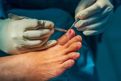 Do Podiatrists Perform Surgery?