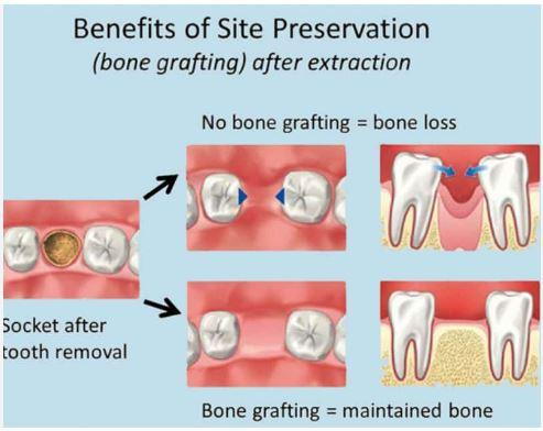 Tooth extraction, bone graft, implant, socket preservation