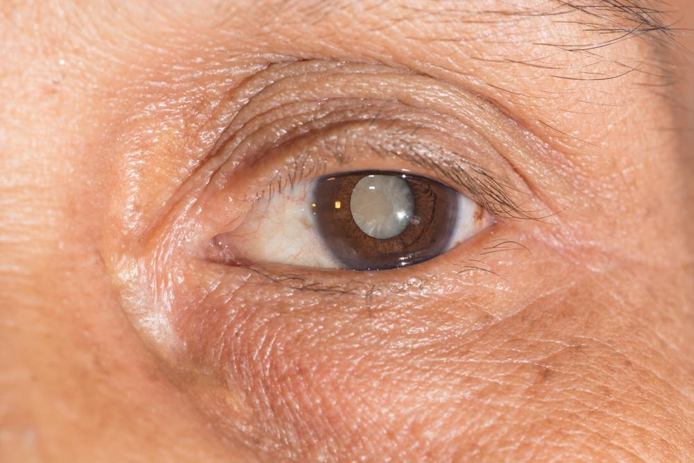 Types of Cataracts and Their Differences