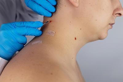 How Skin Cancer Is Diagnosed: The Role of Biopsy and Imaging