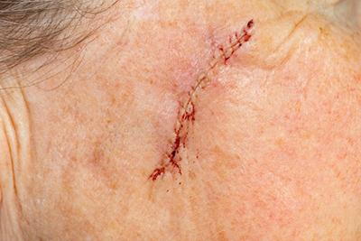 What to Expect Before, During, and After Mohs Surgery