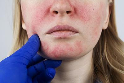 Identifying and Treating Rosacea