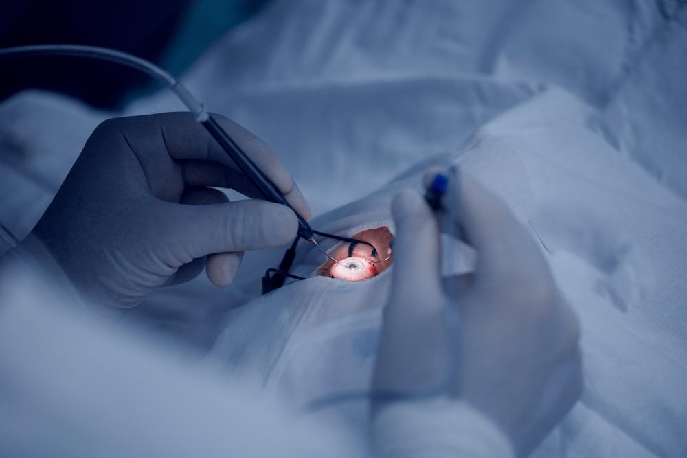 Traditional Vs. Bladeless Cataract Surgery