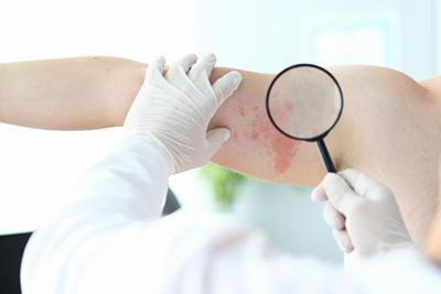 How Dermatologists Diagnose and Treat Skin Rashes