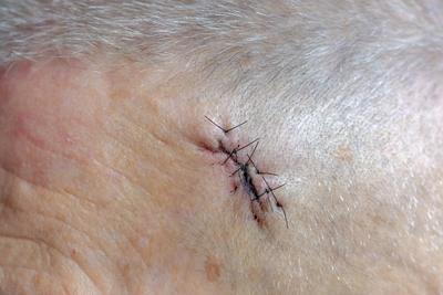 The Advantages of Mohs Surgery Over Traditional Skin Cancer Treatments