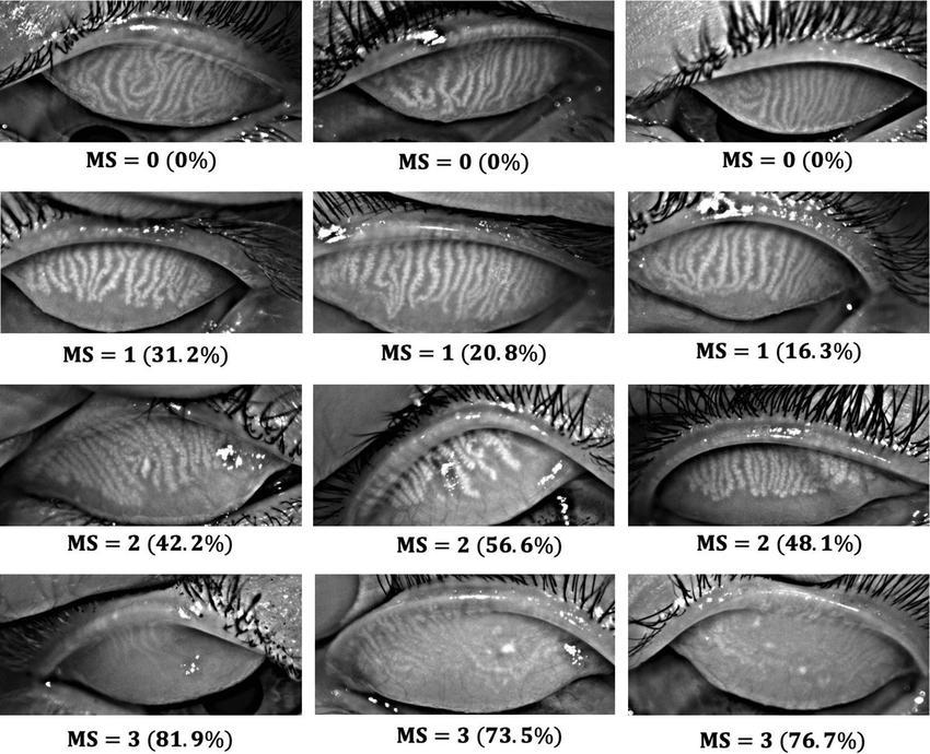 The Importance of Meibography in Diagnosing and Managing Dry Eye Syndrome
