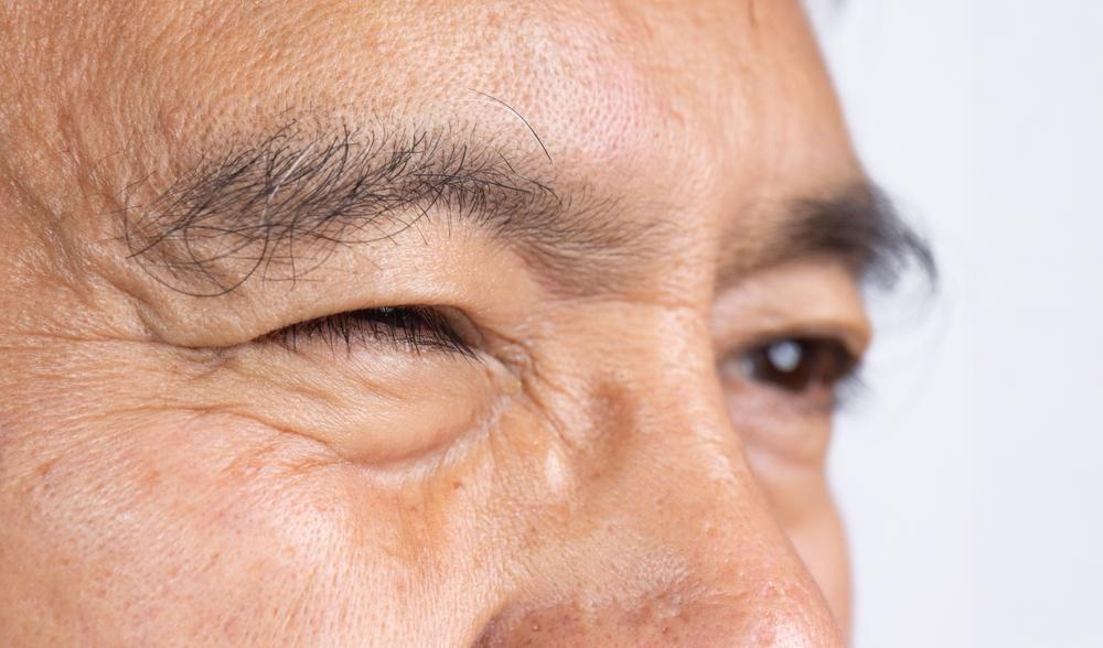 Understanding Blepharospasm: Causes and Symptoms