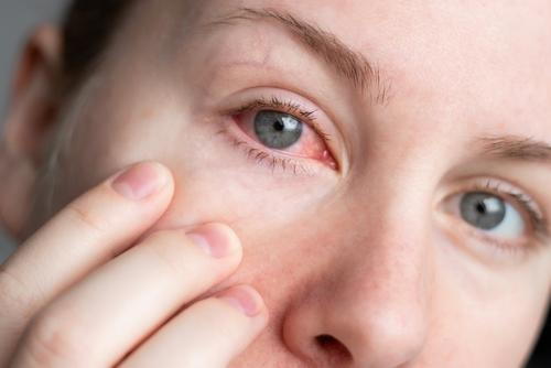 Effective Treatment Options for Common Eye Infections in Columbia, MO