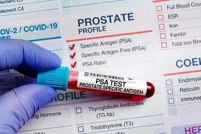 How PSA Screening Can Help Detect Prostate Cancer Early