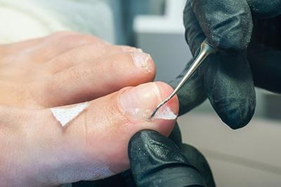 How a Podiatrist Can Help Treat Your Ingrown Toenail