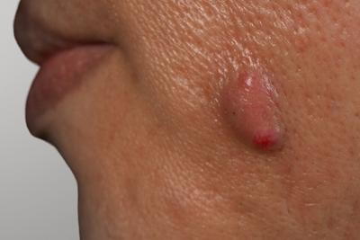 Acne, Boils, and Cysts: What’s Causing Those Lumps and Bumps?