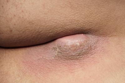 What Is Pilonidal Disease? Causes, Symptoms, and Treatment Options