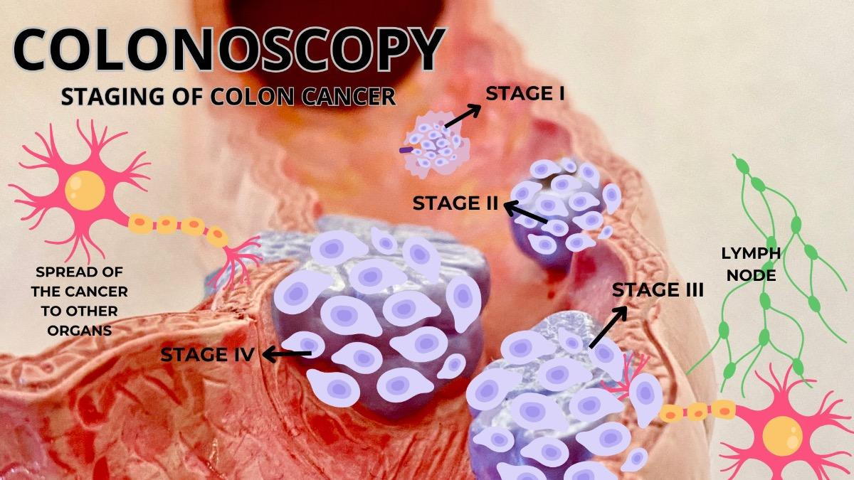 The Importance of Colon Cancer Screenings: Protect Your Health!