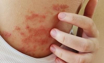 When to See a Doctor for Eczema: Warning Signs and Treatment Options