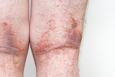 Breakthrough Therapies for Severe Eczema: What Patients Need to Know