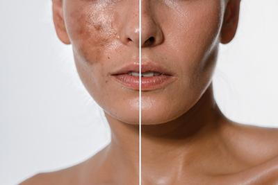 Laser Resurfacing for Hyperpigmentation: How It Can Even Skin Tone