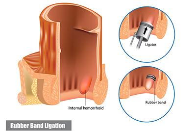 What to Expect During Rubber Band Ligation