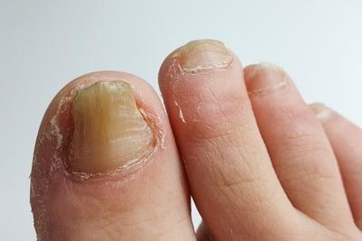Understanding Toenail Fungus: Causes and Risk Factors