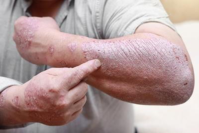Psoriasis 101: Understanding the Basics of this Skin Condition