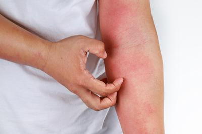 When a Rash Won’t Go Away: Time to See a Dermatologist