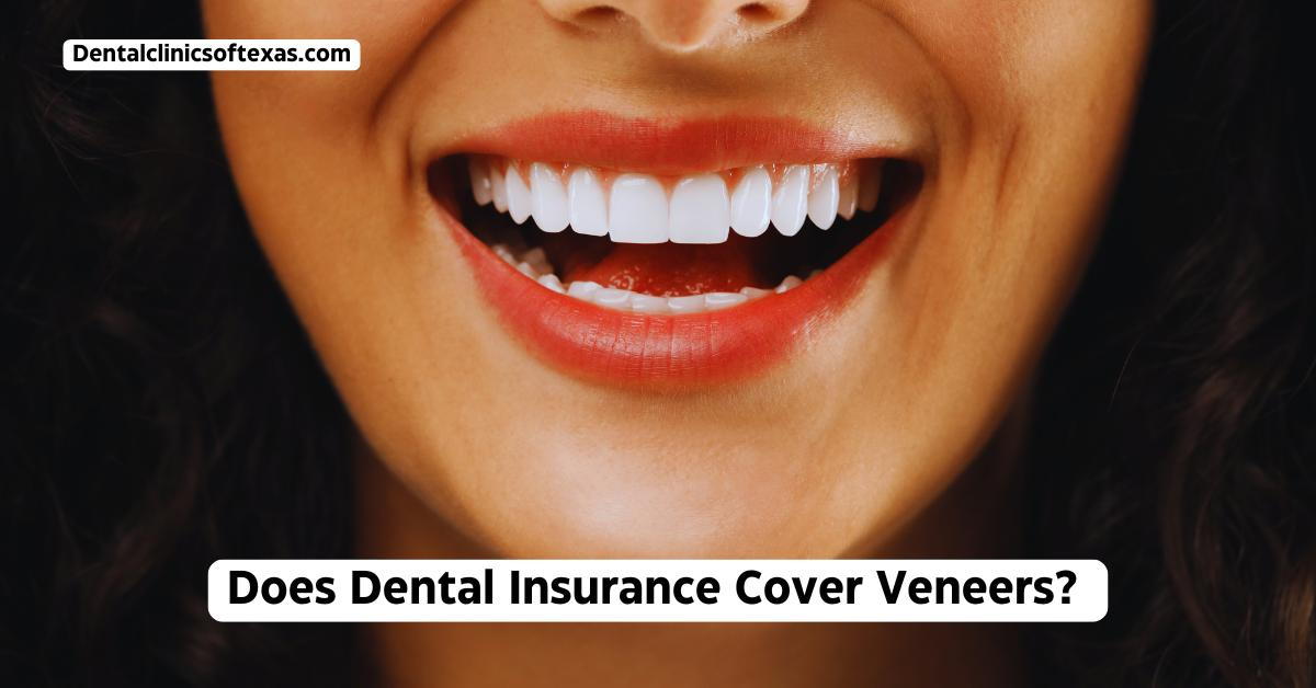 Does Dental Insurance Cover Veneers? A Complete Guide