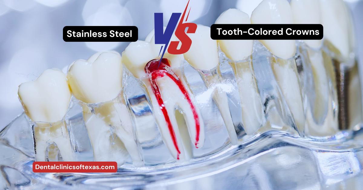Stainless Steel vs. Tooth-Colored Crowns: What’s Best for Your Child?