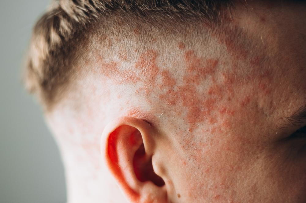 Understanding Eczema: Symptoms, Causes, and Effective Treatments