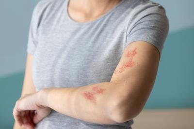 Can Stress Cause Hives? Understanding the Connection