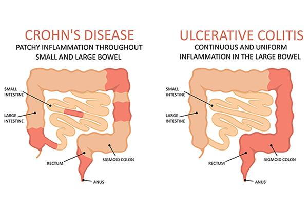 Crohn's Disease vs. Ulcerative Colitis: What’s the Difference?