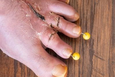 Is Hammer Toe Surgery Right for You? Signs It’s Time to Consider Treat