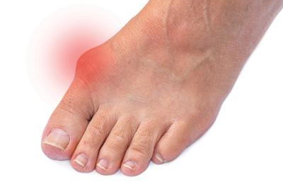 The Connection Between Bunions and Flat Feet