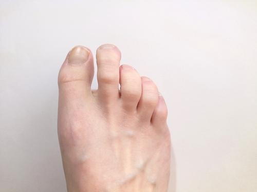 Hammertoes: Causes, Symptoms, and Treatment Options