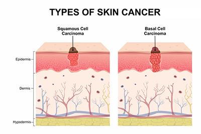 Understanding Basal Cell Vs Squamous Cell Carcinoma