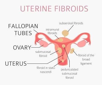 Managing Fibroids