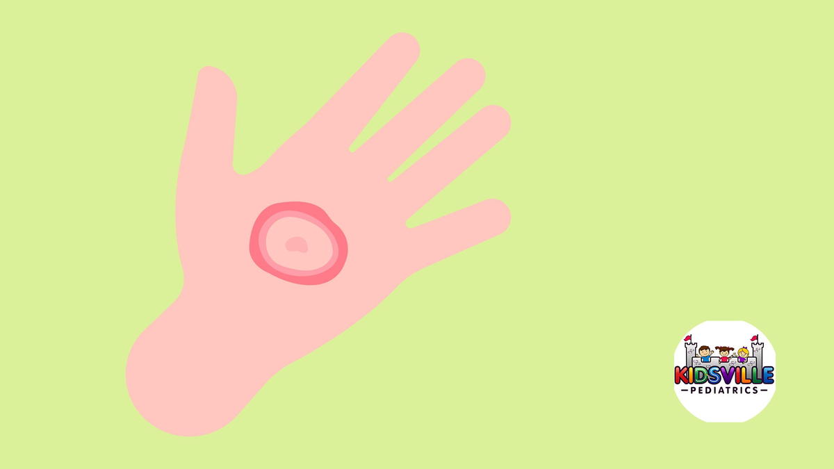 5 Signs of Ringworm You Should Never Ignore