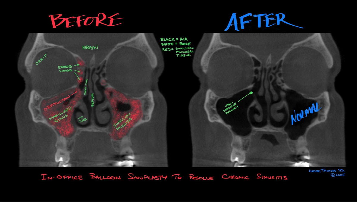 In-Office Sinus CT Scan + Immediate Review by ENT | Sinus Specialist ...