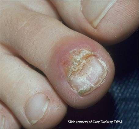 What Are Periungual Warts?